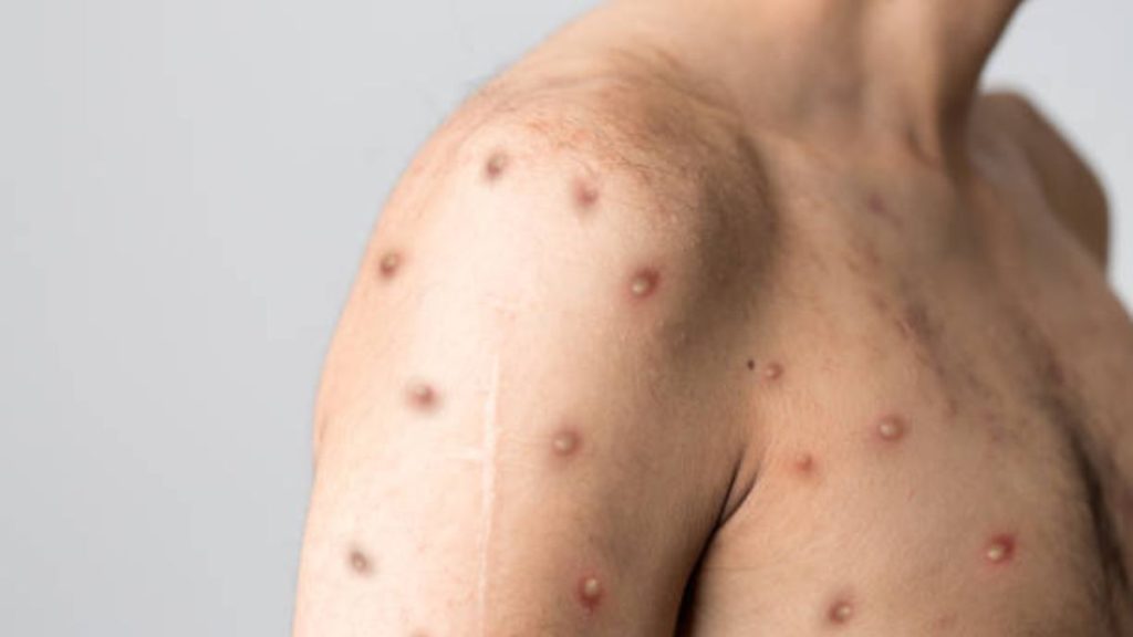 NCDC Records 67 Confirmed Cases Of Mpox In 23 States – Inclusion Magazine